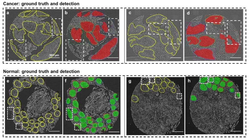 Automatic Colorectal Cancer Screening Using Deep Learning in Spatial ...